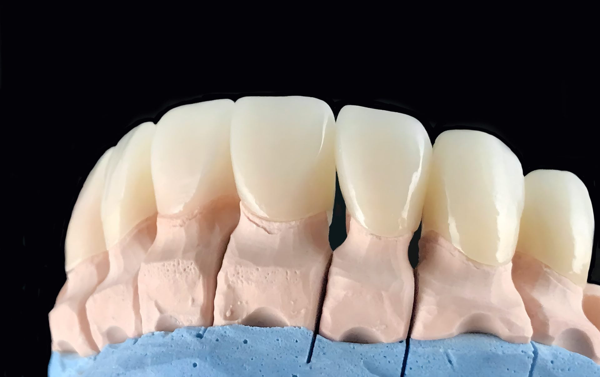 How to Make Your Dental Crowns Look Great with Regular Care?